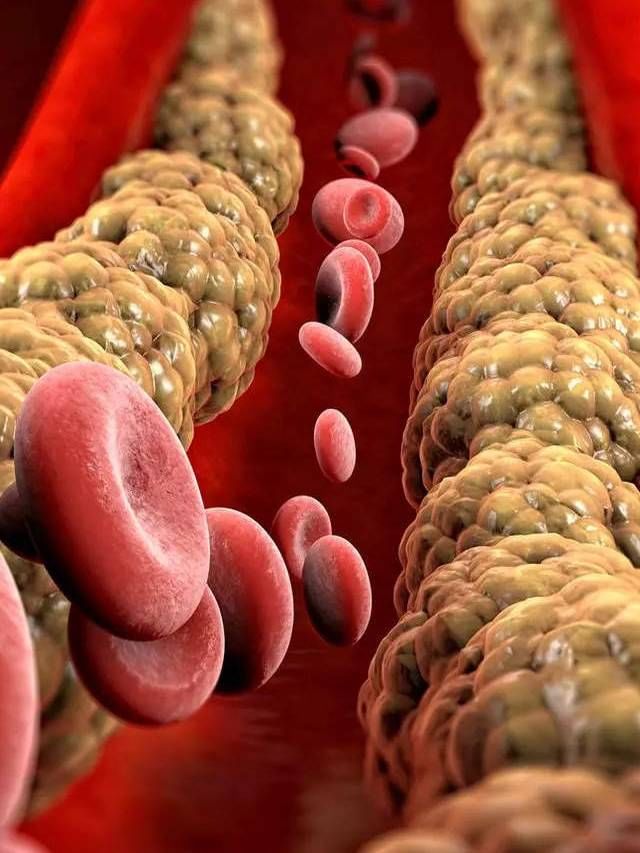 Seeing Clearly: 6 Signs of High Cholesterol You Might Notice in Your ...